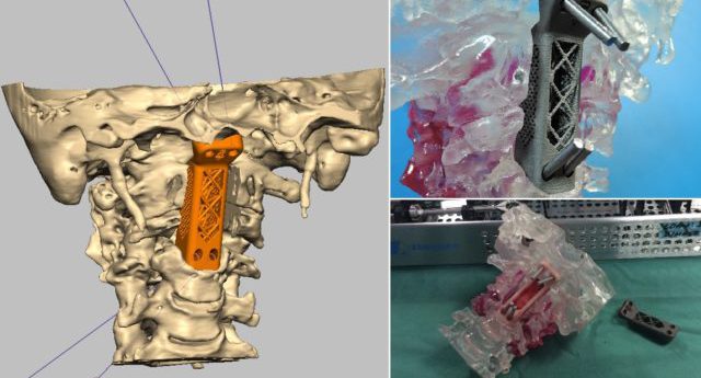 Applications of 3D printing in oncology: approaching challenges ...